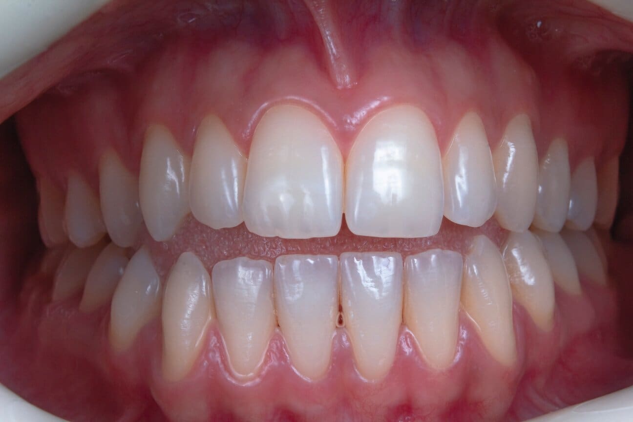 Understanding All the Basics About Your Dental Crowns